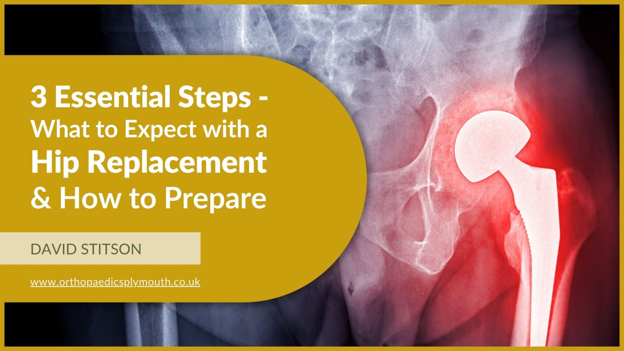 What To Expect With Hip Replacement Surgery & How To Prepare